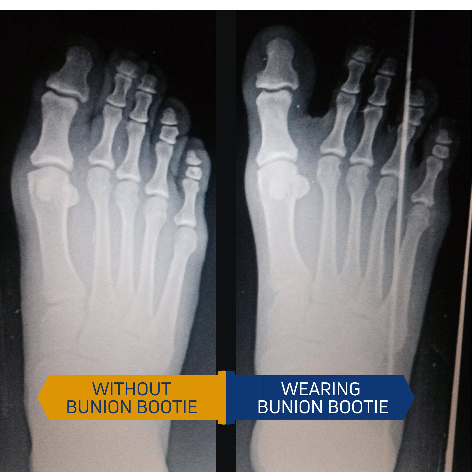 Bunion Corrector for Men & Women Big Toe Straightener for Inside Shoes Socks. Ultra Thin Hallux Valgus Socks to Separate & Straighten Great Toes. Day & Night Splints for Juanetes, X-Large-Left