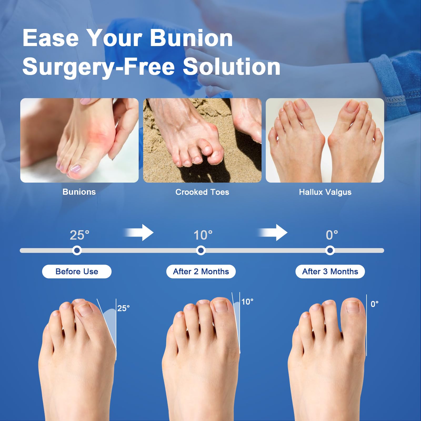 Bunion Corrector for Women Big Toe, Bunion Relief, 8pcs Toe Separators for Overlapping Toes Women, Toe Spacers For Feet Men, Bunion Splint w Pad, Hallux Valgus Toe Straighteners,Fix Bunions No Surgery