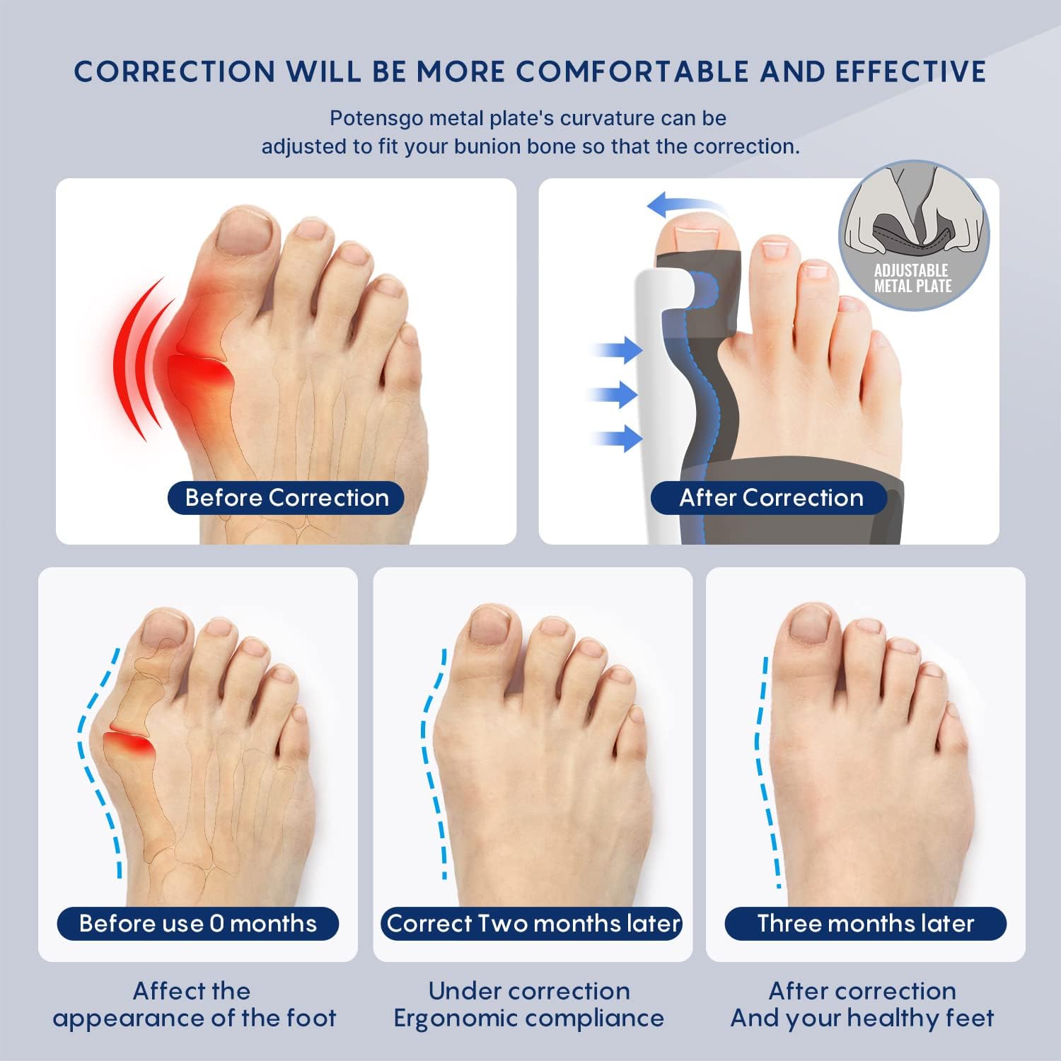 Bunion Corrector Men & Women: 2 Pcs Big Toe Straightener for Bunion Relief - Adjustable Orthopedic Hallux Valgus Corrector for Bunion Splint - Day/Night Support (Black)