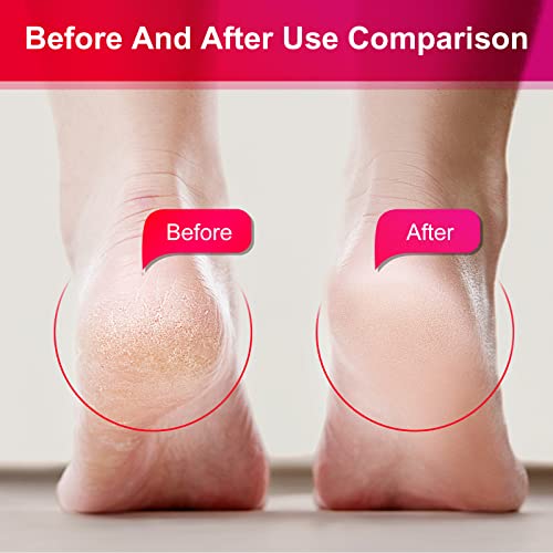 Feet Callus Remover Gel, 12 Packs 8.4 oz with Pumice Stone Scrubber Kit for Professional Pedicure Remove Hard Skins Heels Callouses, Jasmine Scent