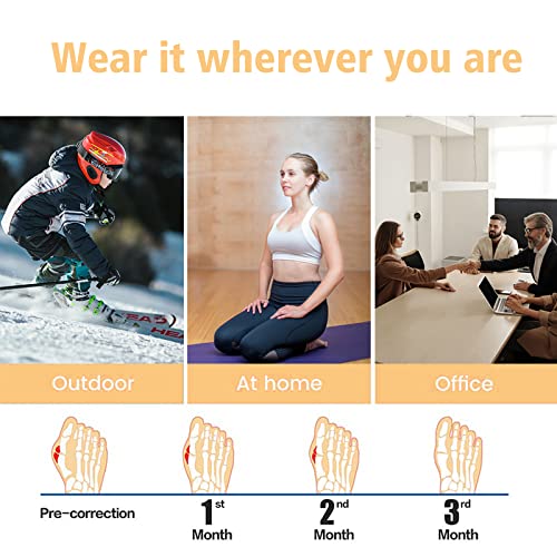 FSHERO Bunion Corrector for Women,Toe Straightener Pain Relief Socks,Bunion Splint,Non-Surgical Hallux Valgus Corrector for Day and Night(Large,Skin)