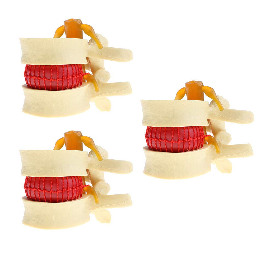 BONEW 4PCS Magnify 2X Human Spine Lumbar Vertebrae Degenerative Disc Medical Model