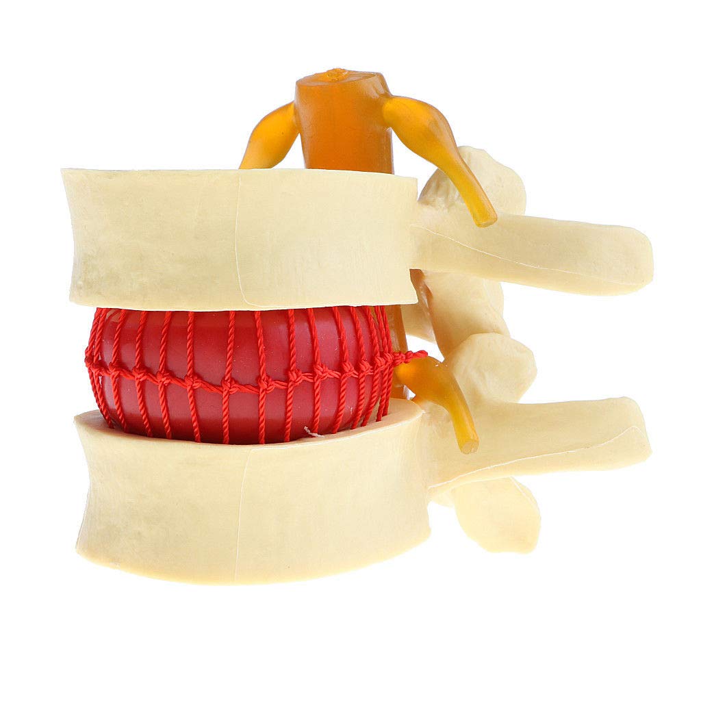 BONEW 4PCS Magnify 2X Human Spine Lumbar Vertebrae Degenerative Disc Medical Model