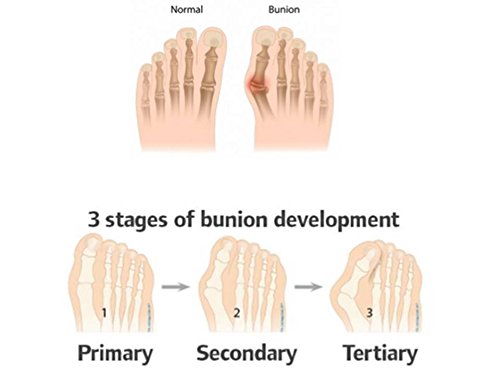 BORT Valco® Hallux Valgus Bunion Night Splint Bunion Corrector Bunion Splint Big Toe Straightener Hammertoe Hallux Valgus Foot Pain Relief Compare to Valguloc Bunion Splint-medium-right