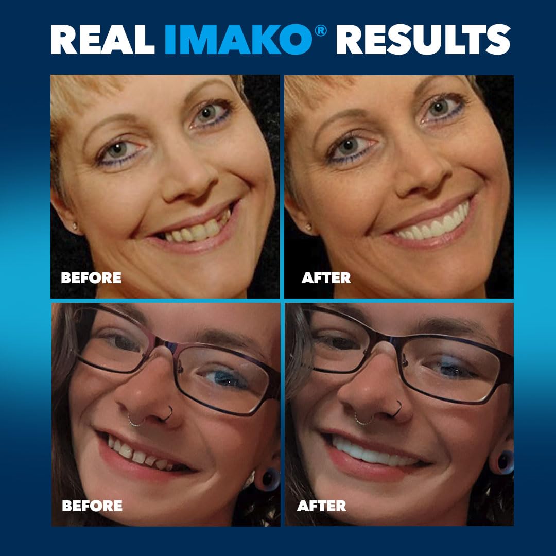 Imako Premium Cosmetic Uppers - 2 Pack - Large, Bleached White - DIY Smile Makeover - Made in USA