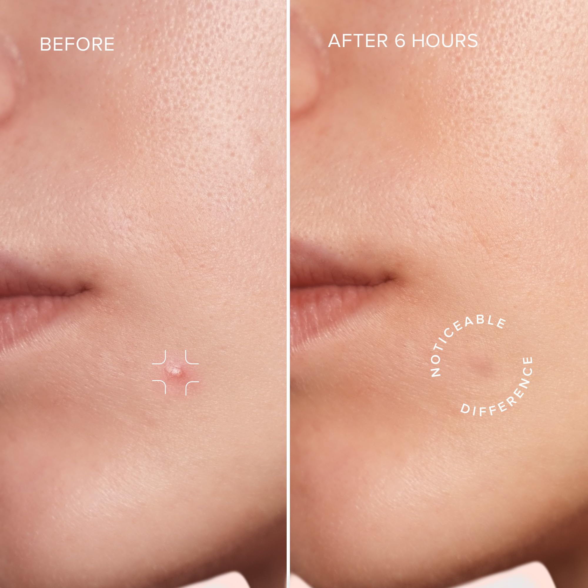 MAREE Star Pimple Patches for Face - Acne Patches - Natural Green Algae Extract & Tea Tree Oil - Hydrocolloid Stars Cute Zit Stickers, Parches Para Acne - 72 Marine Collagen Blemish Pimple Dots