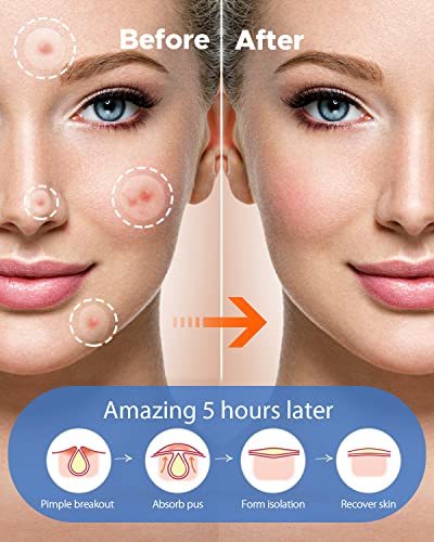 LitBear Acne Pimple Patches- Day and Night 4 Sizes 180 Dots Thin & Thick Hydrocolloid Patches with Witch Hazel, Tea Tree & Calendula Oil, Extra Adhesion Pimple Patches for Face Zit Patch Acne Dots