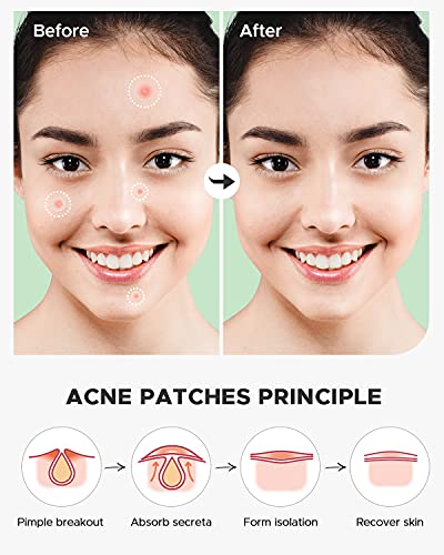ZATKTK Acne Pimple Patch (180 Counts 4 Sizes), Invisible Hydrocolloid Acne Patch with Tea Tree Oil & Calendula Oil, Acne Spot Healing Patch Zit Patches for Face