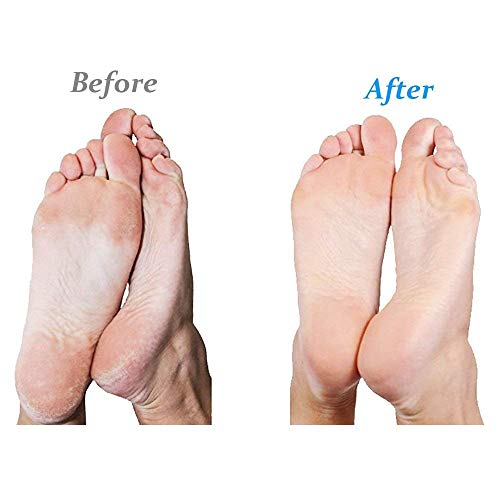 Emjoi Micro-Pedi 3D POWER Callus Remover with Xtreme Coarse Soft & Flexible Roller (Most Powerful & Corded)