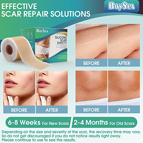 (1.6" x 150" Roll-3.8M) Professional Silicone Scar Sheets - Scars Removal Treatment - Reusable Silicone Scar Strips Type for Keloid, C-Section, Surgery, Burn, Acne et