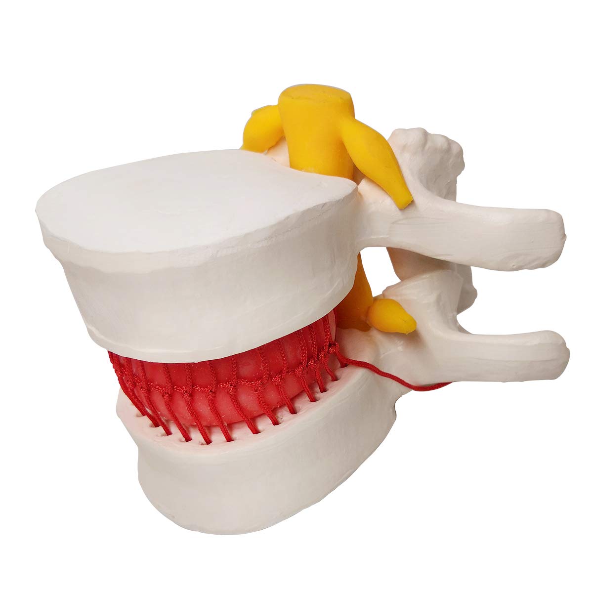 Human Herniated Disc Model, Anatomical Herniated Lumbar Vertebrae Disc Prolapse Model for Medical Teaching Learning, Kids Learning Education Display Toolning, Kids Learning Education Display Tool