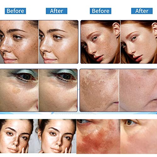Inlifay Dark Spot Remover for Face Hyperpigmentation Treatment. Dark Spots, Melasma, Freckle, Sun Spots Removal Dark Spot Corrector Cream for Women and Men