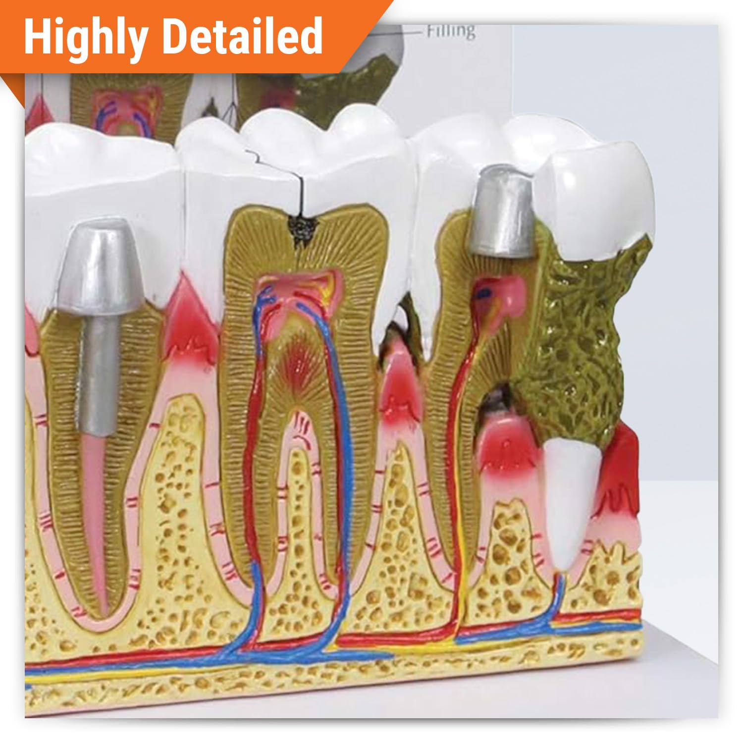 Dental Model | Human Body Anatomy Replica of Teeth w/Common Pathologies for Dentist Office Educational Tool | GPI Anatomicals