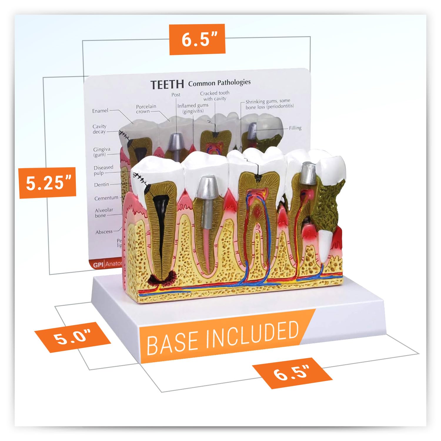 Dental Model | Human Body Anatomy Replica of Teeth w/Common Pathologies for Dentist Office Educational Tool | GPI Anatomicals