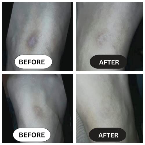 Dark Spot Corrector, Dark Spot Remover for Face, Melasma and Hyperpigmentation Treatment, Dark Spot Serum, Age Spot Remover, with Tyrostat, Kojic Acid, Alpha Arbutin, Mulberry Extract, Lactic Acid 1oz