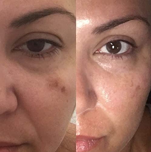 Dark Spot Corrector, Dark Spot Remover for Face, Melasma and Hyperpigmentation Treatment, Dark Spot Serum, Age Spot Remover, with Tyrostat, Kojic Acid, Alpha Arbutin, Mulberry Extract, Lactic Acid 1oz