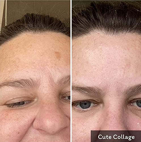 Dark Spot Corrector, Dark Spot Remover for Face, Melasma and Hyperpigmentation Treatment, Dark Spot Serum, Age Spot Remover, with Tyrostat, Kojic Acid, Alpha Arbutin, Mulberry Extract, Lactic Acid 1oz