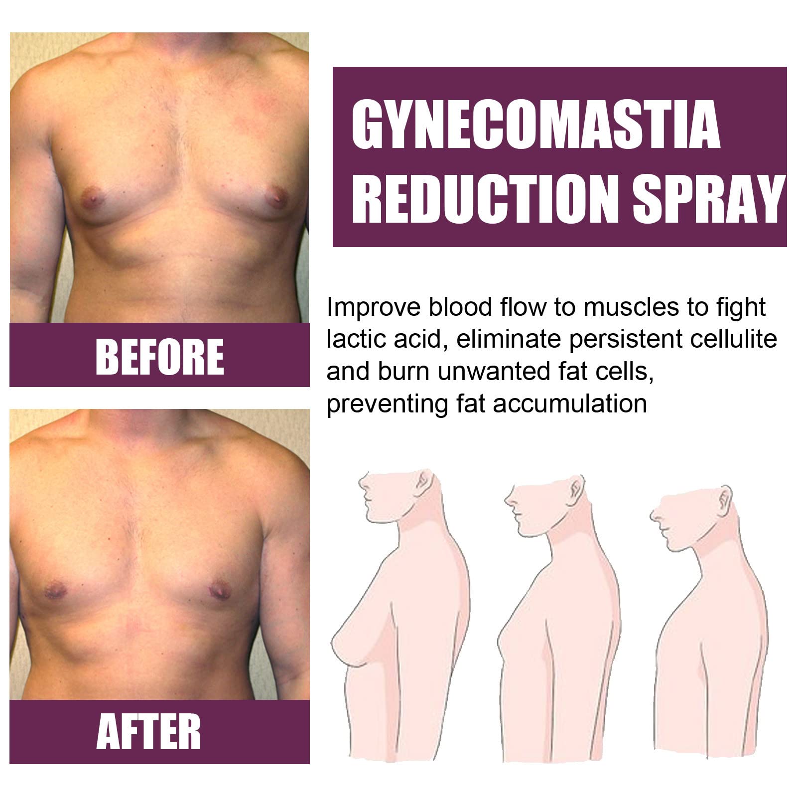 Gynecomastia Reduction Spray, Gynecomastia Chest Tightening Spray Reduction Cellulite Spray, Auchest Chest Cellulite Burner Spray, Prevent Sagging Chest Slim Down (30ml)