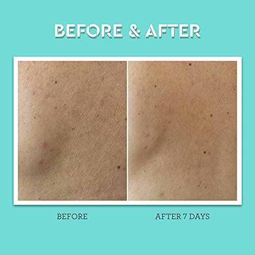 Bliss Clear Genius Body Acne Spray - 3.5 Fl Oz - Maximum Strength 2% Salicylic Acid & Niacinamide - Targets Body Acne & Prevents Future Breakouts - Post Workout - Clean - Vegan & Cruelty-Free