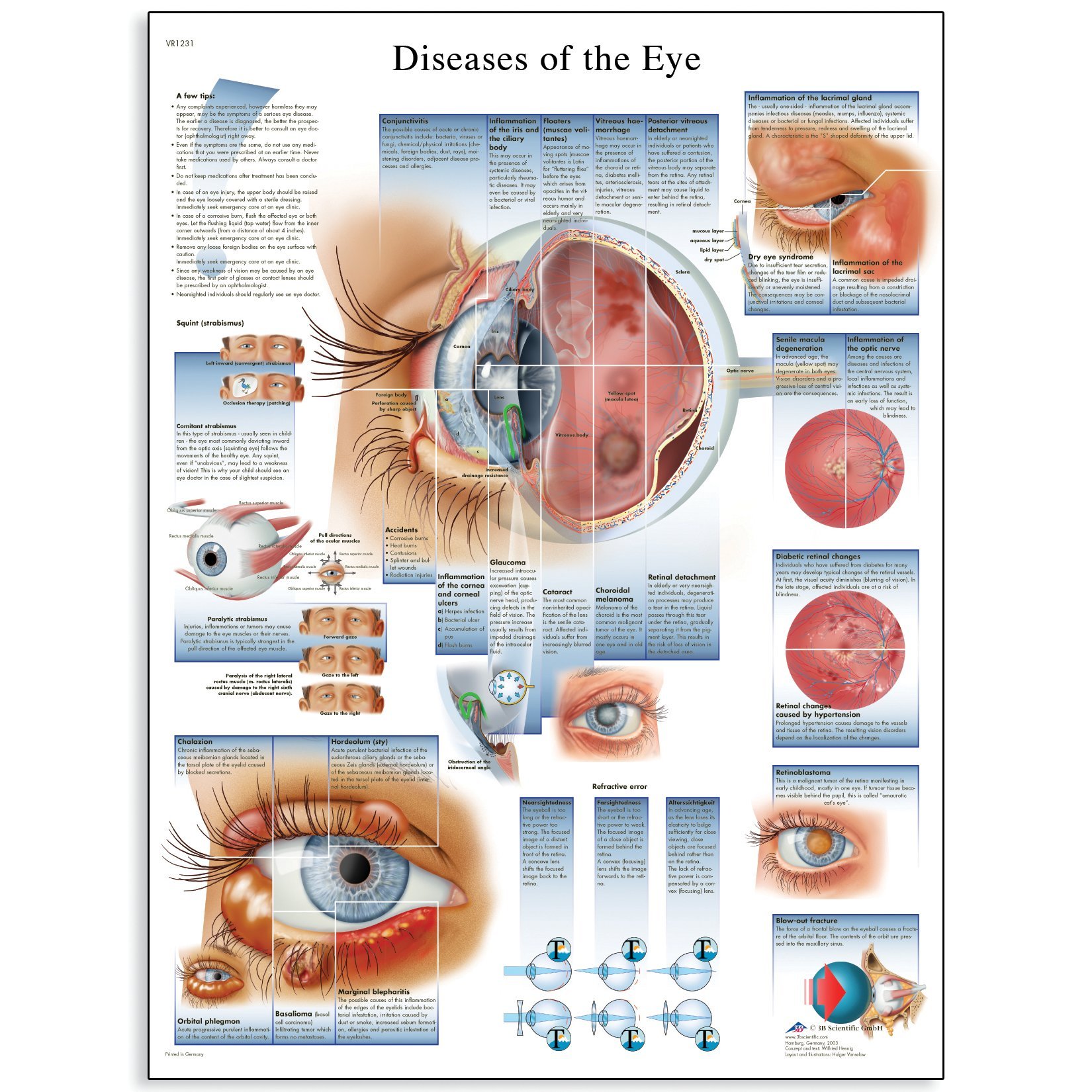 3B Scientific VR1231UU Glossy Paper Diseases of The Eye Anatomical Chart, Poster Size 20" Width x 26" Height