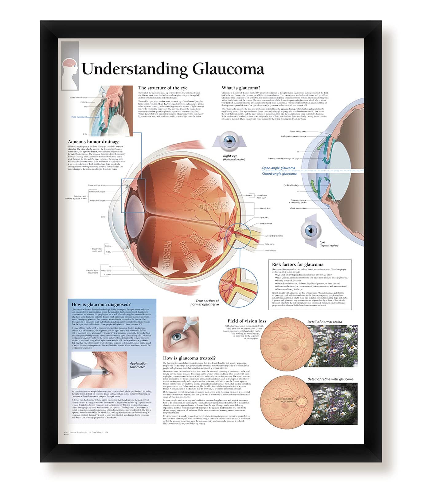 Set of 2 Framed Medical Posters The Eye and Understanding Glaucoma 22"x28" Wall Diagrams