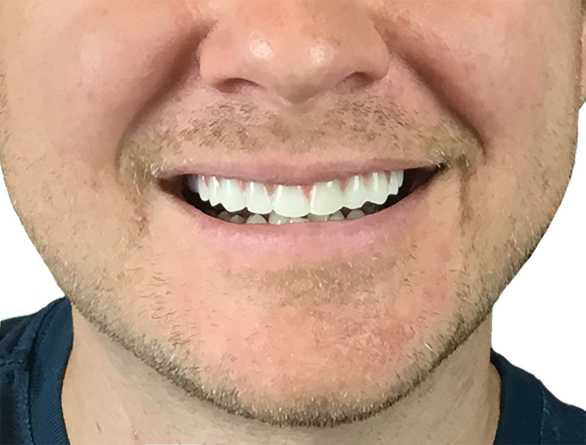 Veneers Teeth for Women and Men Natural Shade Comfort Fit Flex Snap on Veneers for Snap Covering Missing Teeth whitening Replacements Protect Your Teeth and regain a Confident Smile