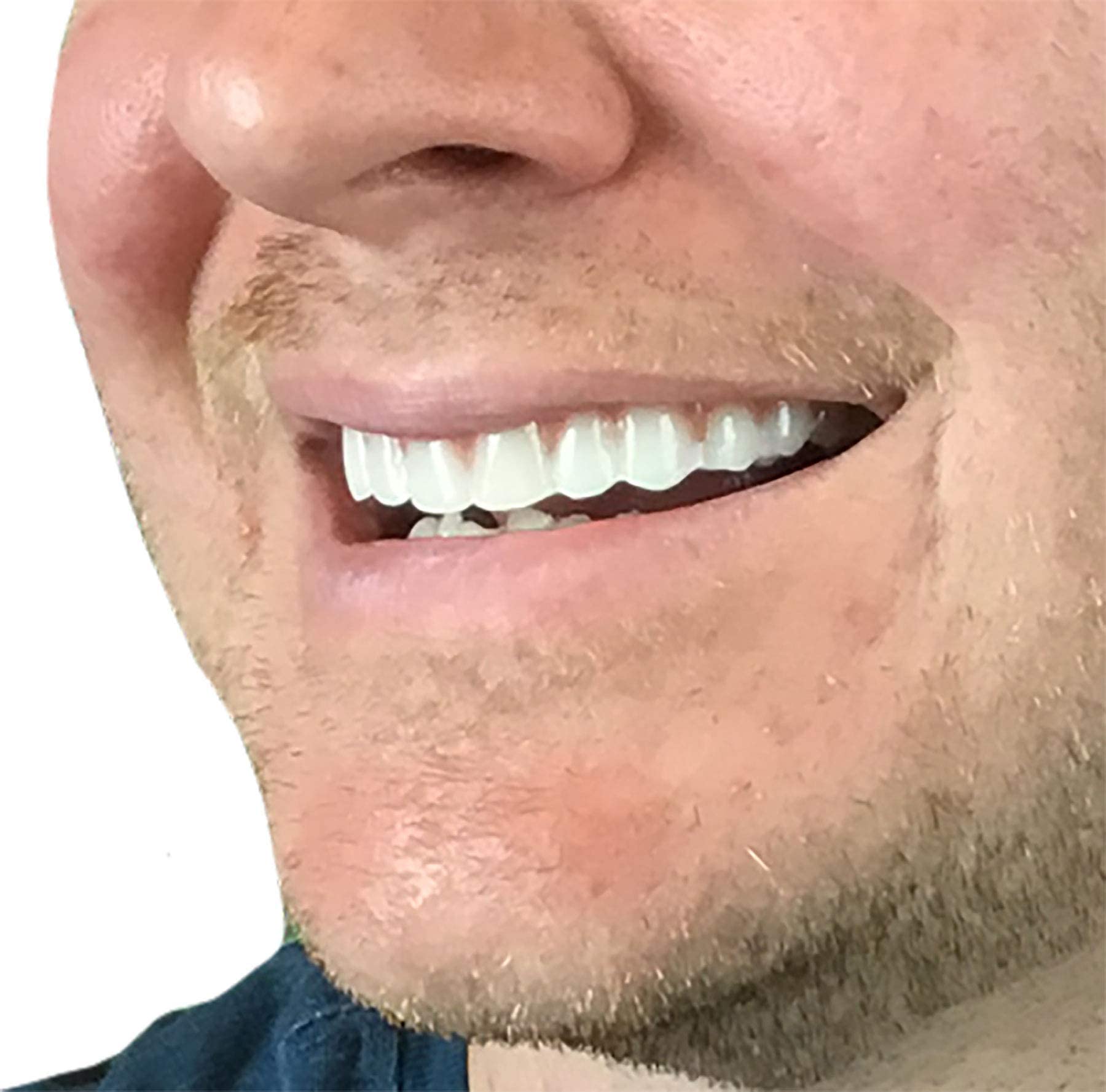 Veneers Teeth for Women and Men Natural Shade Comfort Fit Flex Snap on Veneers for Snap Covering Missing Teeth whitening Replacements Protect Your Teeth and regain a Confident Smile