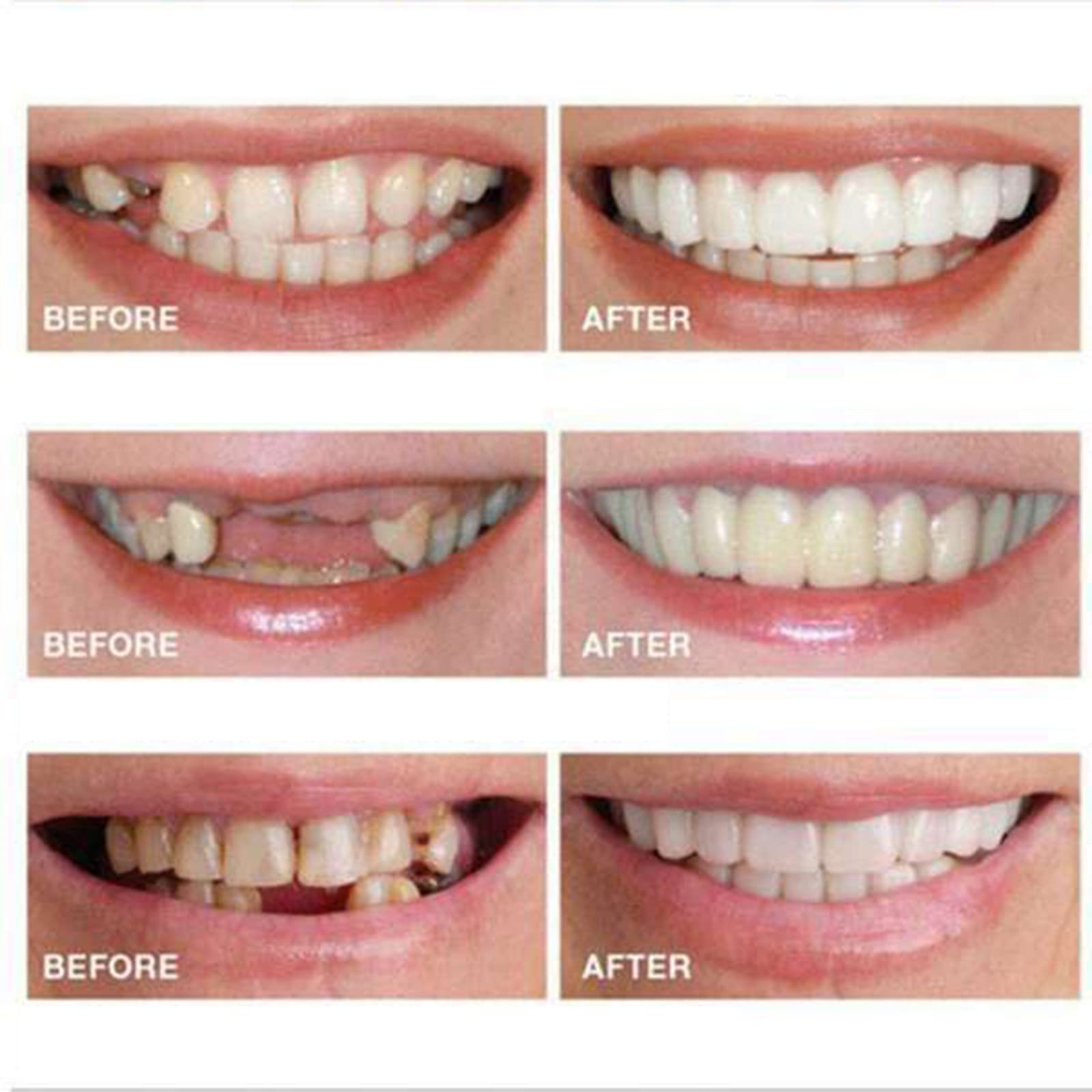 Dentures Fake Smile Teeth Moldable Customizable Temporary Top Teeth for Snap on Instant & Confidence Smile(Non-Porous 3Boxes)
