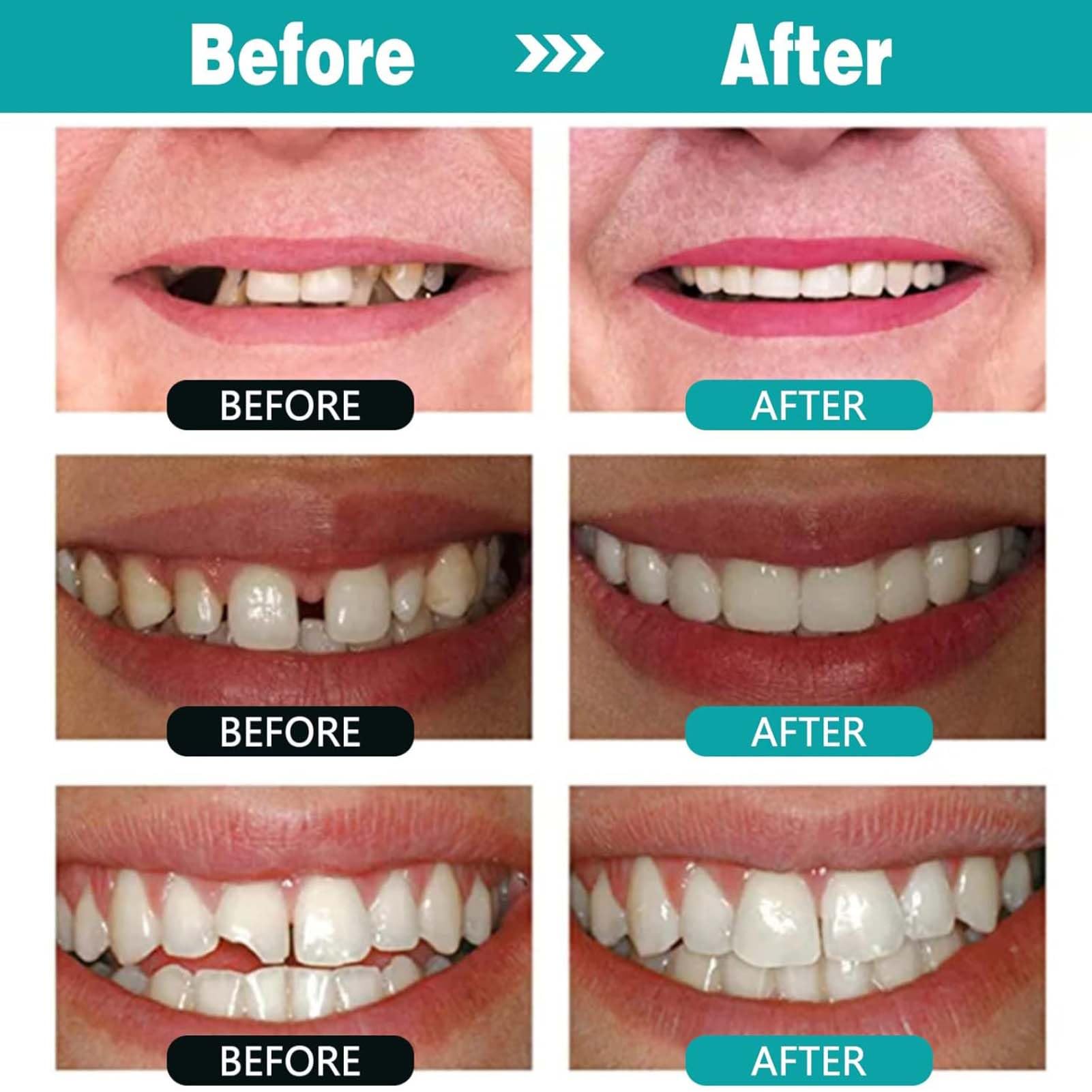Ganbaro Moldable False Teeth, Teeth Repair Kit, Tooth Repair Granules, Temp Tooth Beads with 4 Dental Tools, Snap On Instant and Confident Smile
