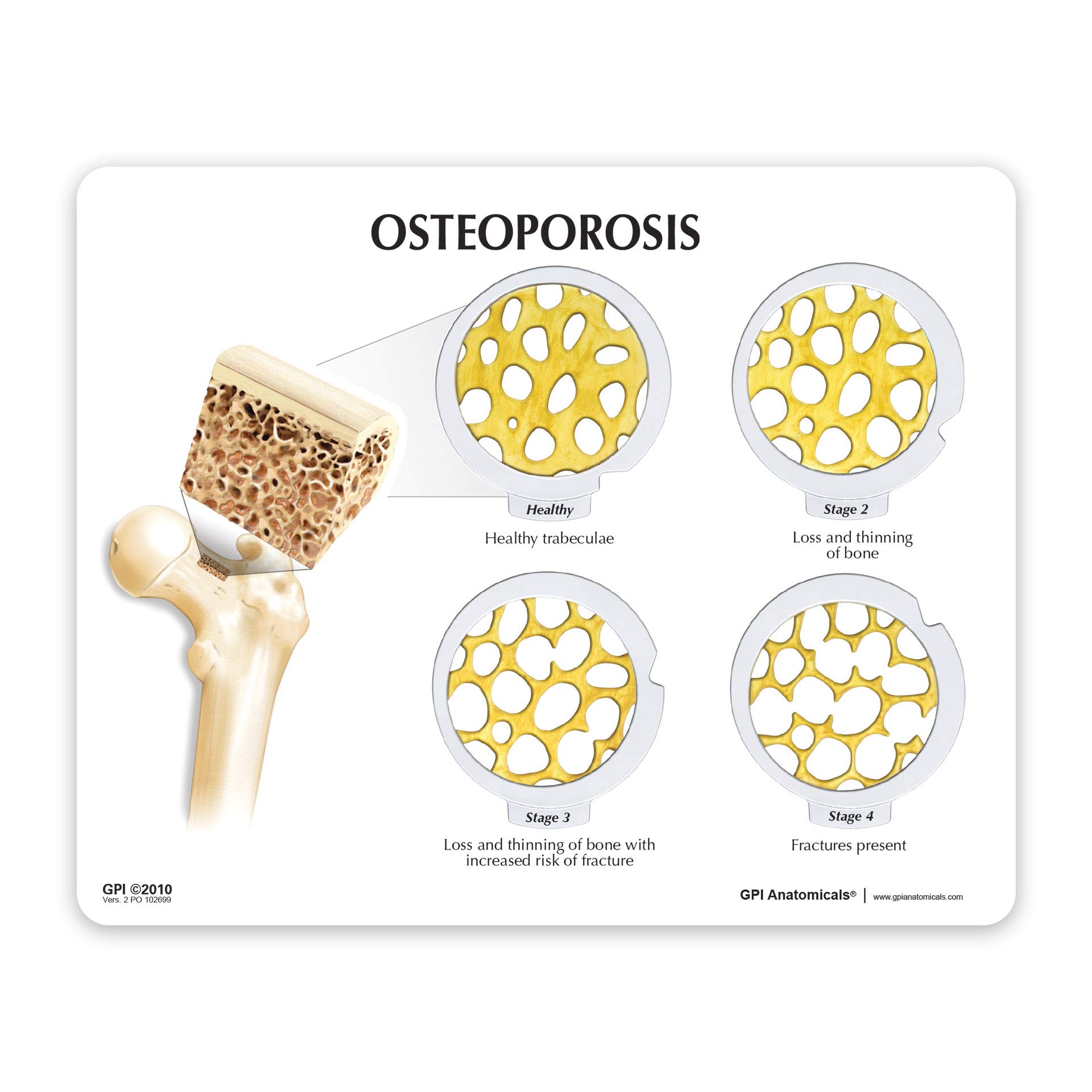 Osteoporosis Model | Human Body Anatomy Four Piece Hinged Disk Set of Progressive Bone Thinning for Doctors Office Educational Tool | GPI Anatomicals