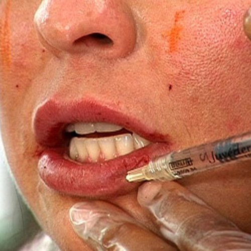 The Complete Guide to Dermal Filler Injections - Learn How To Inject Juvederm - Learn How To Inject Radiesse - This Advanced Radiesse Training Video / Juvederm Training Video Shows Injection Techniques for Medical Aesthetics Training