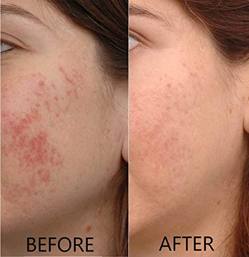 Vitamin C Serum 20% Pure L-Ascorbic Acid, Ferulic Acid, Vitamin E and Hyaluronic Acid for Face and Eyes Natural Anti Aging Anti Wrinkle 1oz. by Dr. Brenner (1 oz)