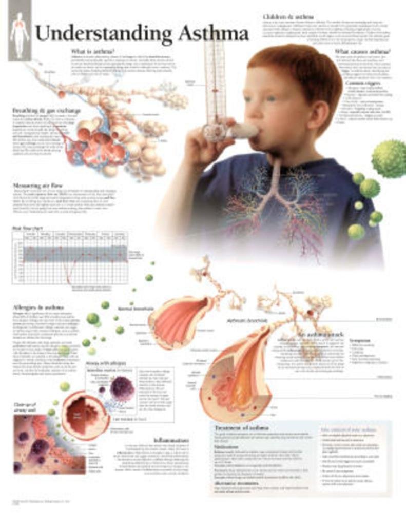 Understanding Asthma chart: Laminated Wall Chart