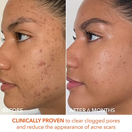 Dr. Dennis Gross Alpha Beta Extra Strength Daily Peel: for Oily Skin, Uneven Tone or Texture, Wrinkles or Enlarged Pores (5 Treatments)