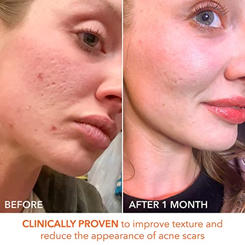 Dr. Dennis Gross Alpha Beta Extra Strength Daily Peel: for Oily Skin, Uneven Tone or Texture, Wrinkles or Enlarged Pores (5 Treatments)