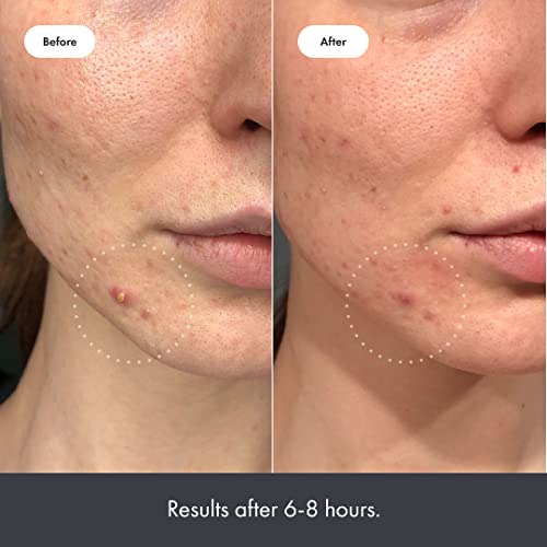 Mighty Patch Invisible+ from Hero Cosmetics - Daytime Hydrocolloid Acne Pimple Patches for Covering Zits and Blemishes, Ultra Thin Spot Stickers for Face and Skin, Vegan-friendly and Not Tested on Animals (39 Count)