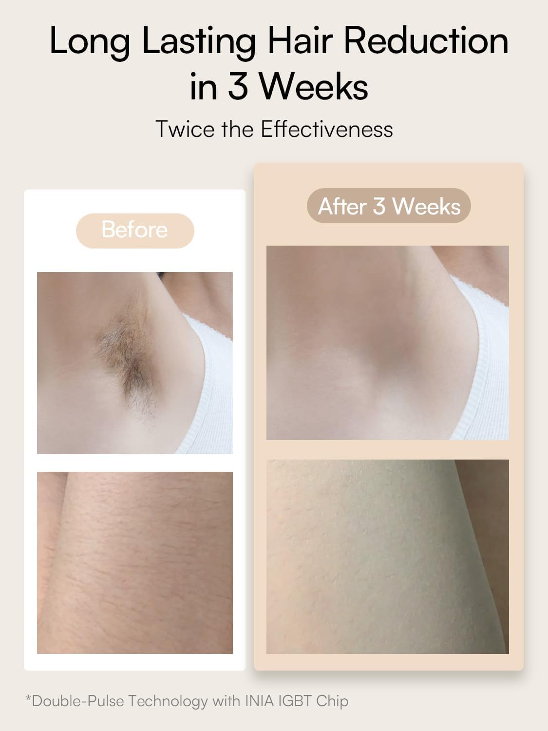 INIA Laser Hair Removal for Women and Men, IPL Hair Removal Device with Sapphire Ice-Cooling, Double Effectiveness & 5 Flashes per Second for Long-Lasting and Nearly Painless Results