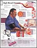 High Blood Pressure chart: Laminated Wall Chart