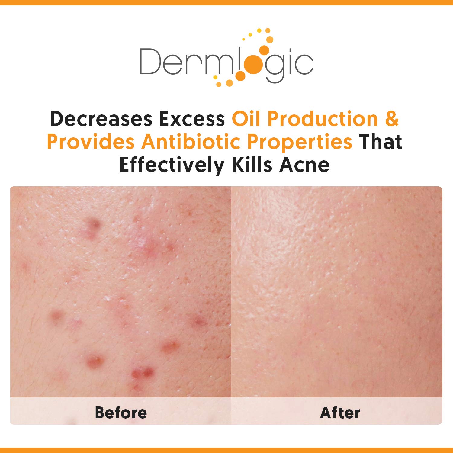 Dermlogic Acne Face & Body Cream- Maximum Strength Treatment for Cystic, Blackhead & Whitehead Pimples. Prevents Future Breakouts.