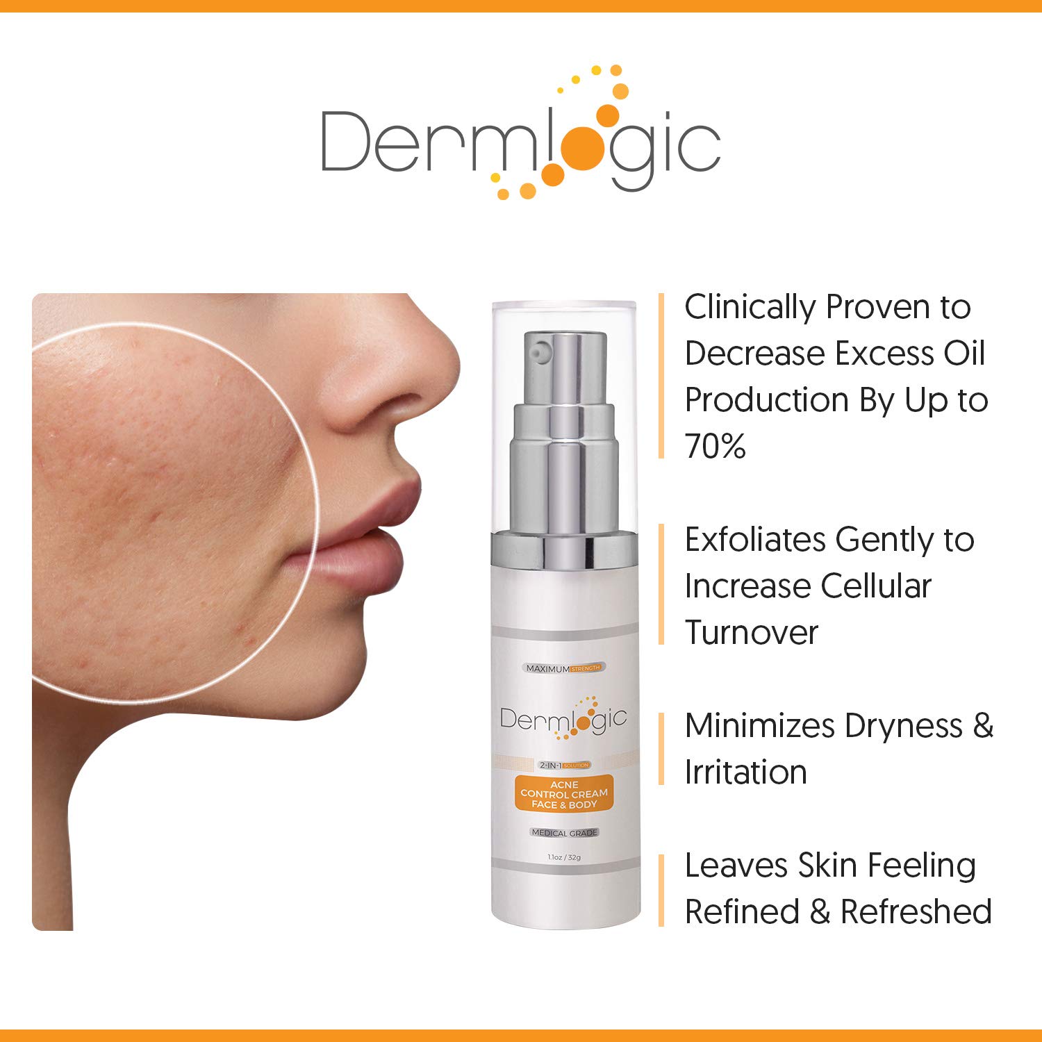 Dermlogic Acne Face & Body Cream- Maximum Strength Treatment for Cystic, Blackhead & Whitehead Pimples. Prevents Future Breakouts.