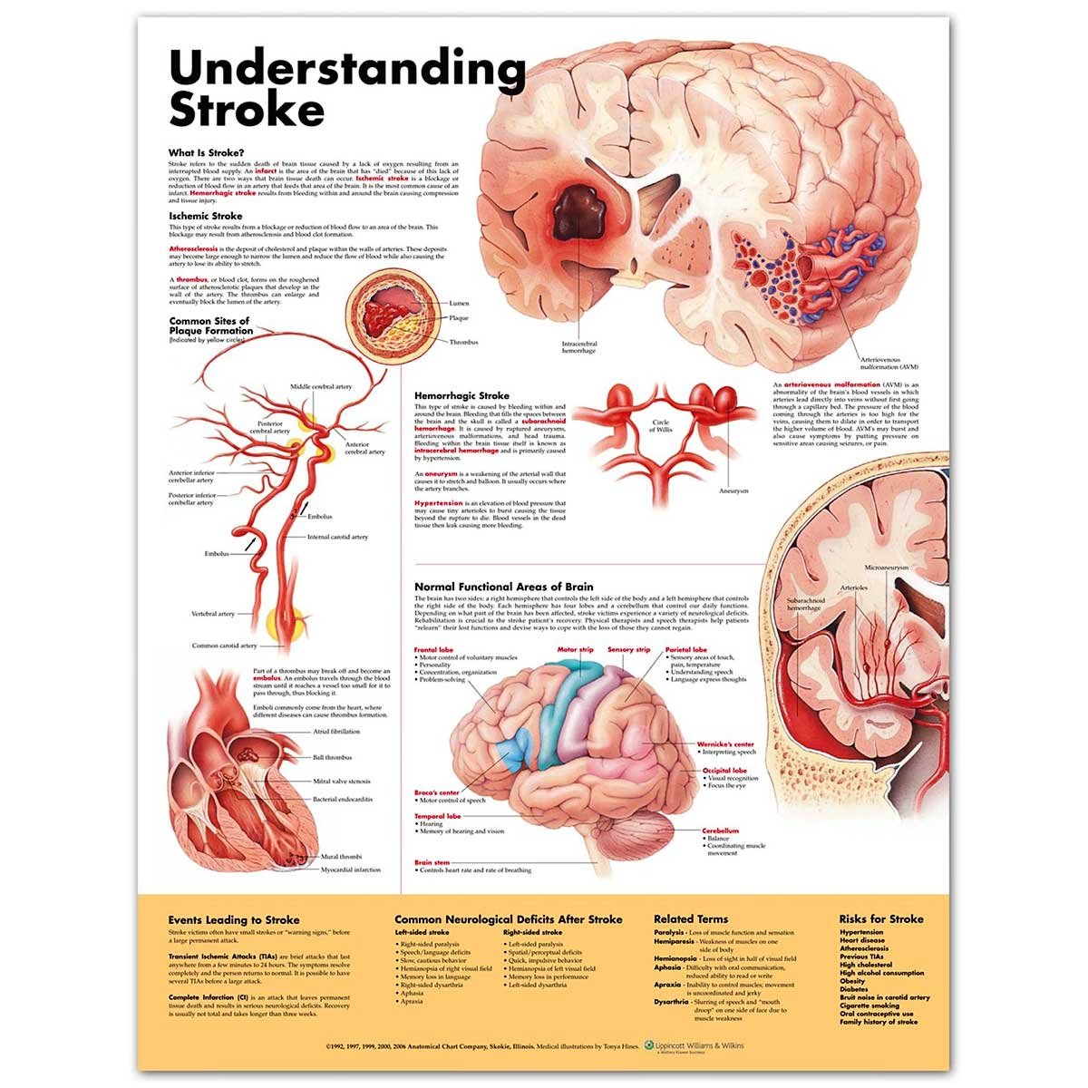 Understanding Stroke Anatomical Chart