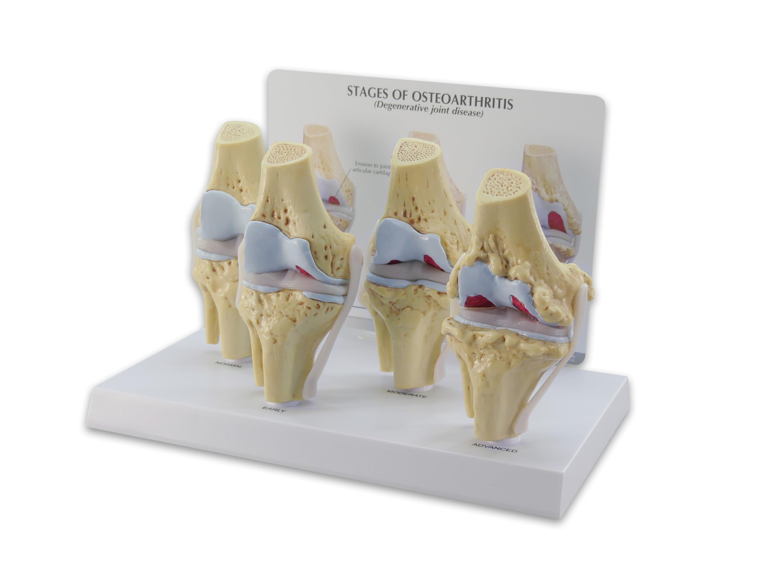 GPI Anatomicals Knee Joint Model Set | Human Body Anatomy Replica Set of 4-Stage Osteoarthritis Knee Joint for Doctors Office Educational Tool