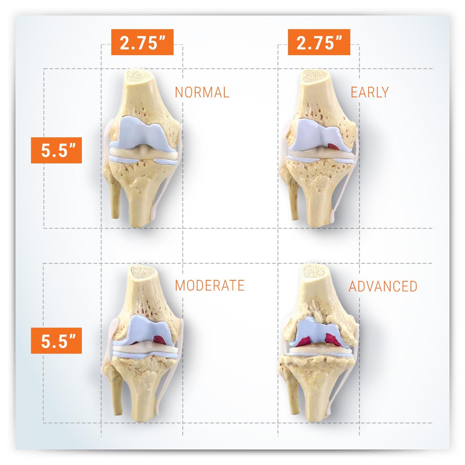 GPI Anatomicals Knee Joint Model Set | Human Body Anatomy Replica Set of 4-Stage Osteoarthritis Knee Joint for Doctors Office Educational Tool