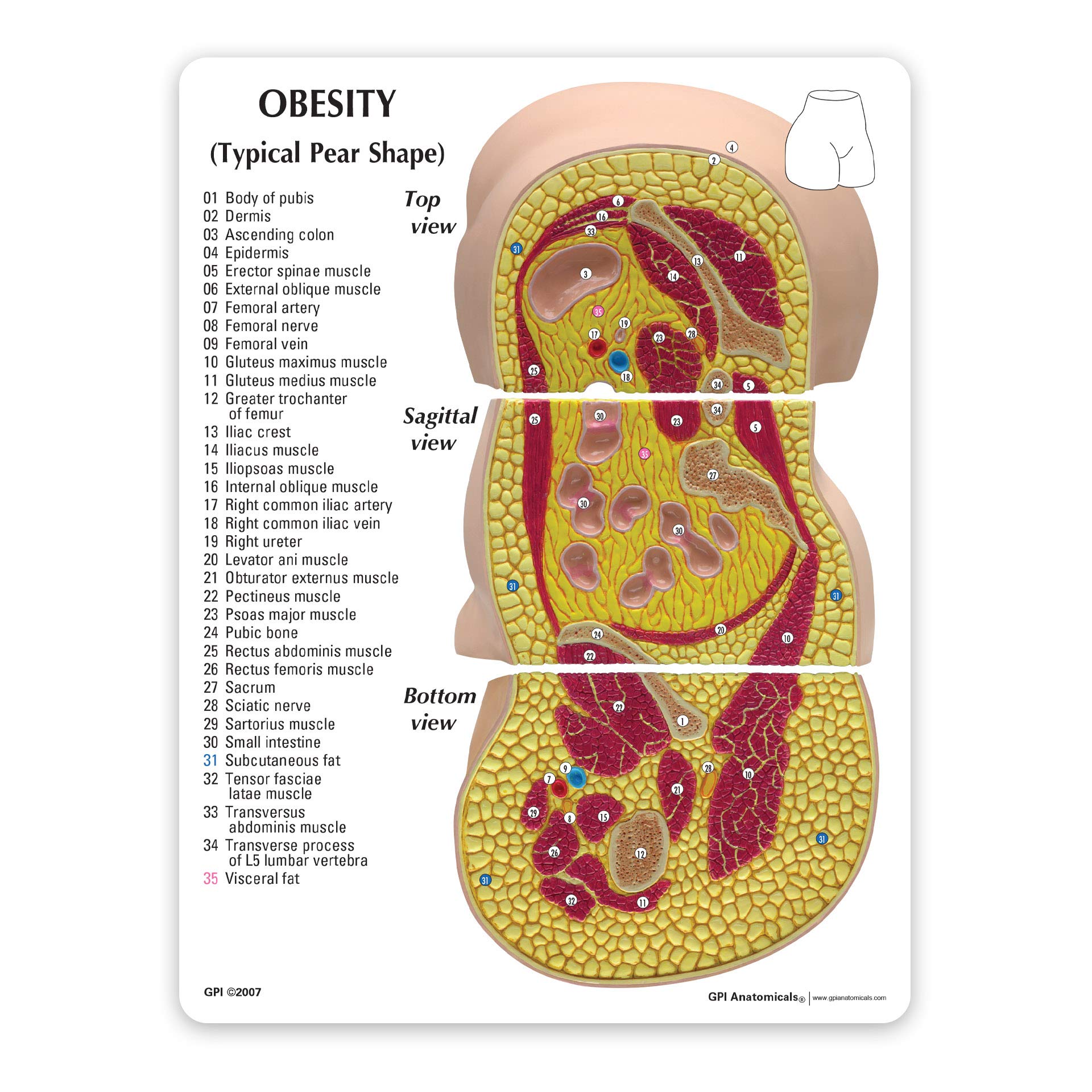 Obesity Model | Human Body Anatomy Replica of Overweight Body Types for Doctors Office Educational Tool | GPI Anatomicals