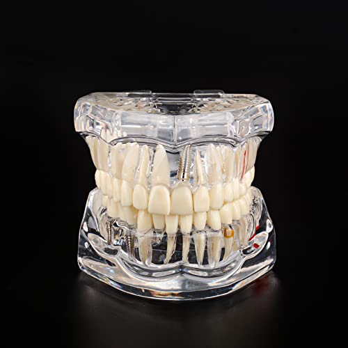 Ultrassist Transparent Disease Teeth Model with Dental Implant Bridge, Dental Model for Patient and Dental Student Education