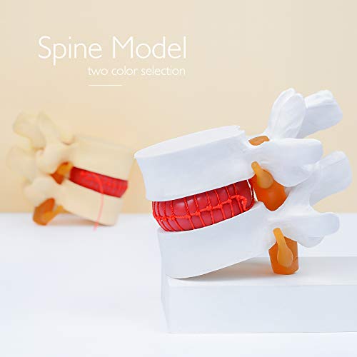 Anatomical Herniated Lumbar Vertebrae Disc Prolapse Model Human Medical Anatomy