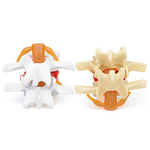 Anatomical Herniated Lumbar Vertebrae Disc Prolapse Model Human Medical Anatomy