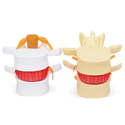 Anatomical Herniated Lumbar Vertebrae Disc Prolapse Model Human Medical Anatomy