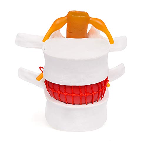 Anatomical Herniated Lumbar Vertebrae Disc Prolapse Model Human Medical Anatomy
