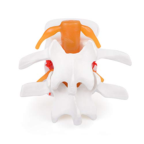 Anatomical Herniated Lumbar Vertebrae Disc Prolapse Model Human Medical Anatomy